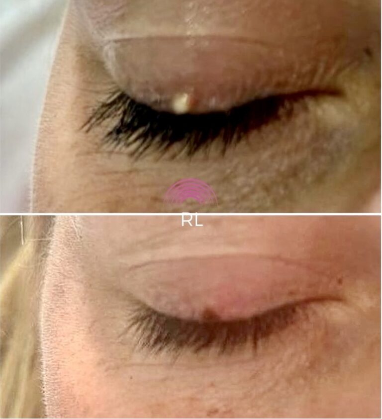 How do you get rid of milia on eyelids? Here's how...